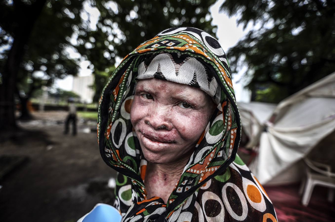 El drama de los albinos de Tanzania - elnortedecastilla.es